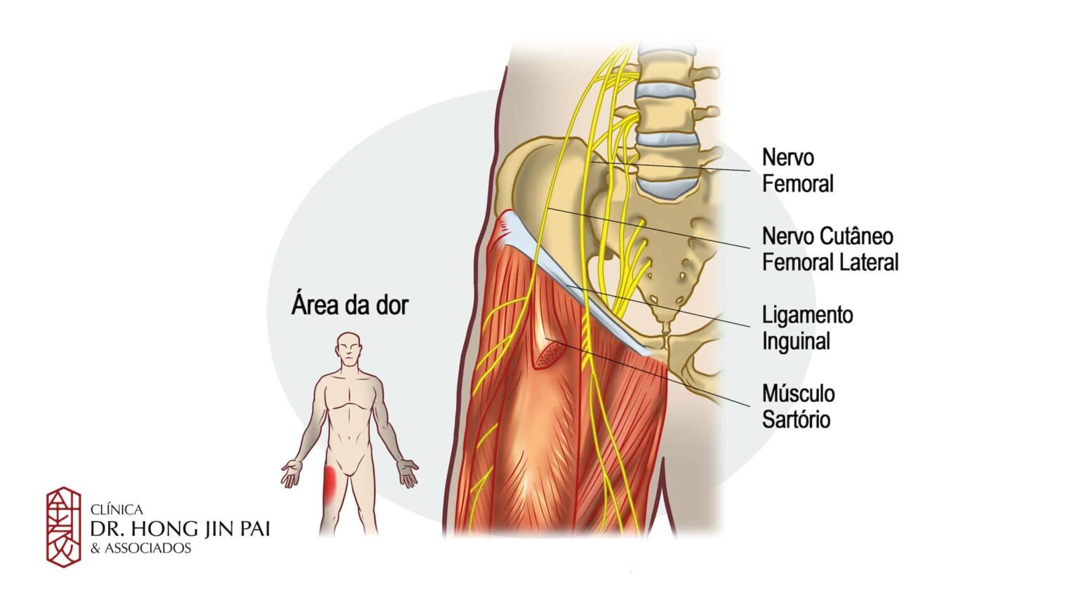 Meralgia Parestésica - Dor e Queimação na região Anterior da Coxa ...